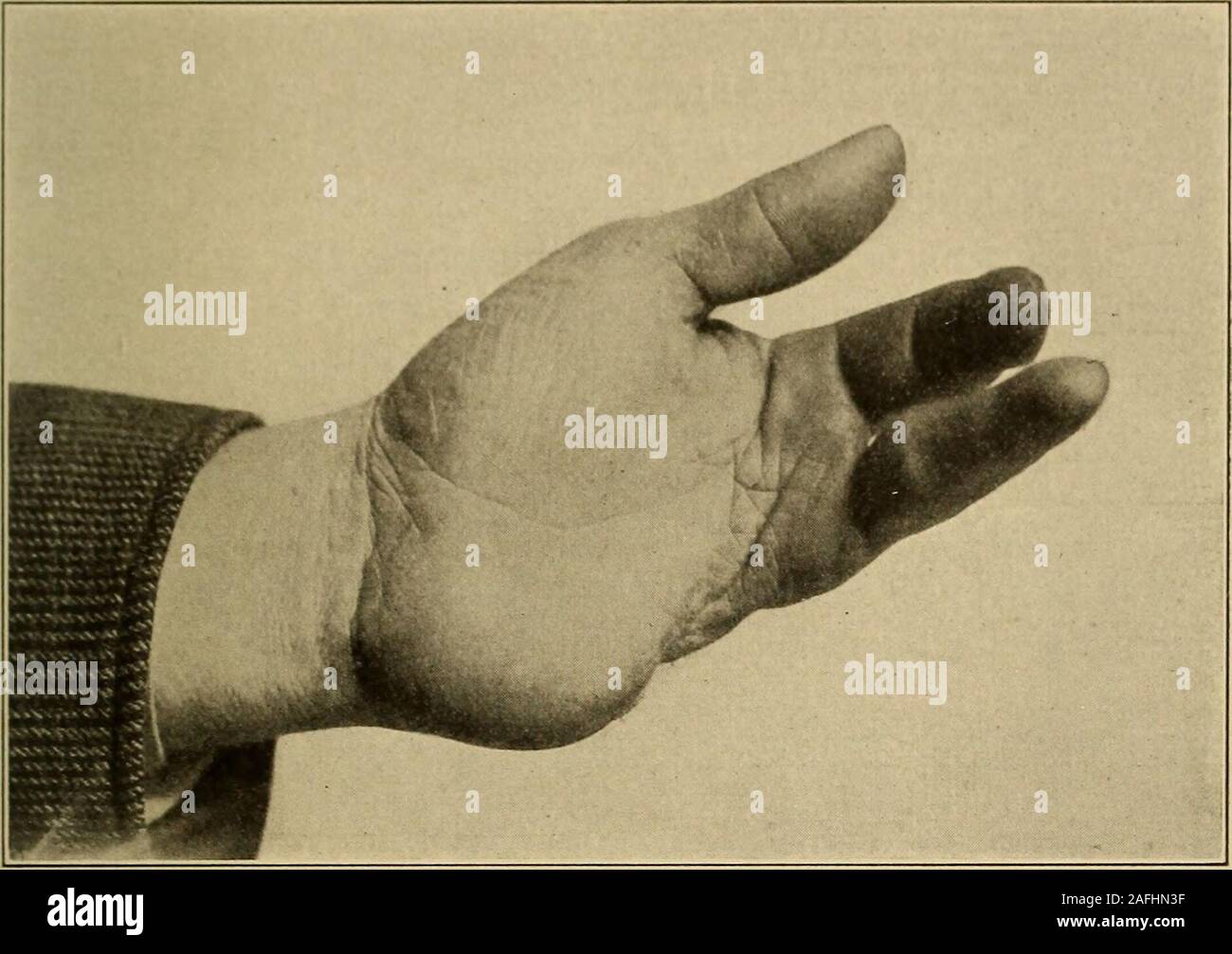 Dorsum of the hand hi-res stock photography and images - Alamy