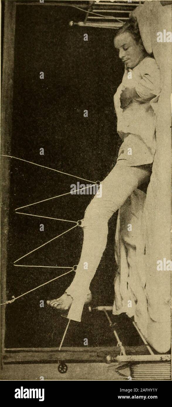 Match splint hi-res stock photography and images - Alamy