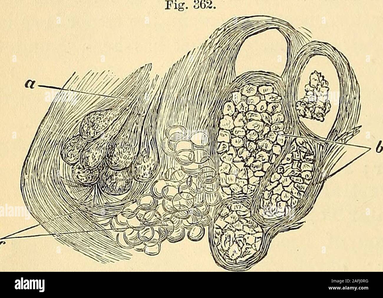 Fluid cysts hi-res stock photography and images - Alamy