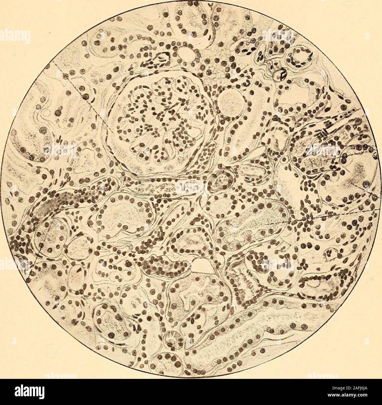 . A practical study of malaria. Fig. 2. The kidneys in blackwater fever ...