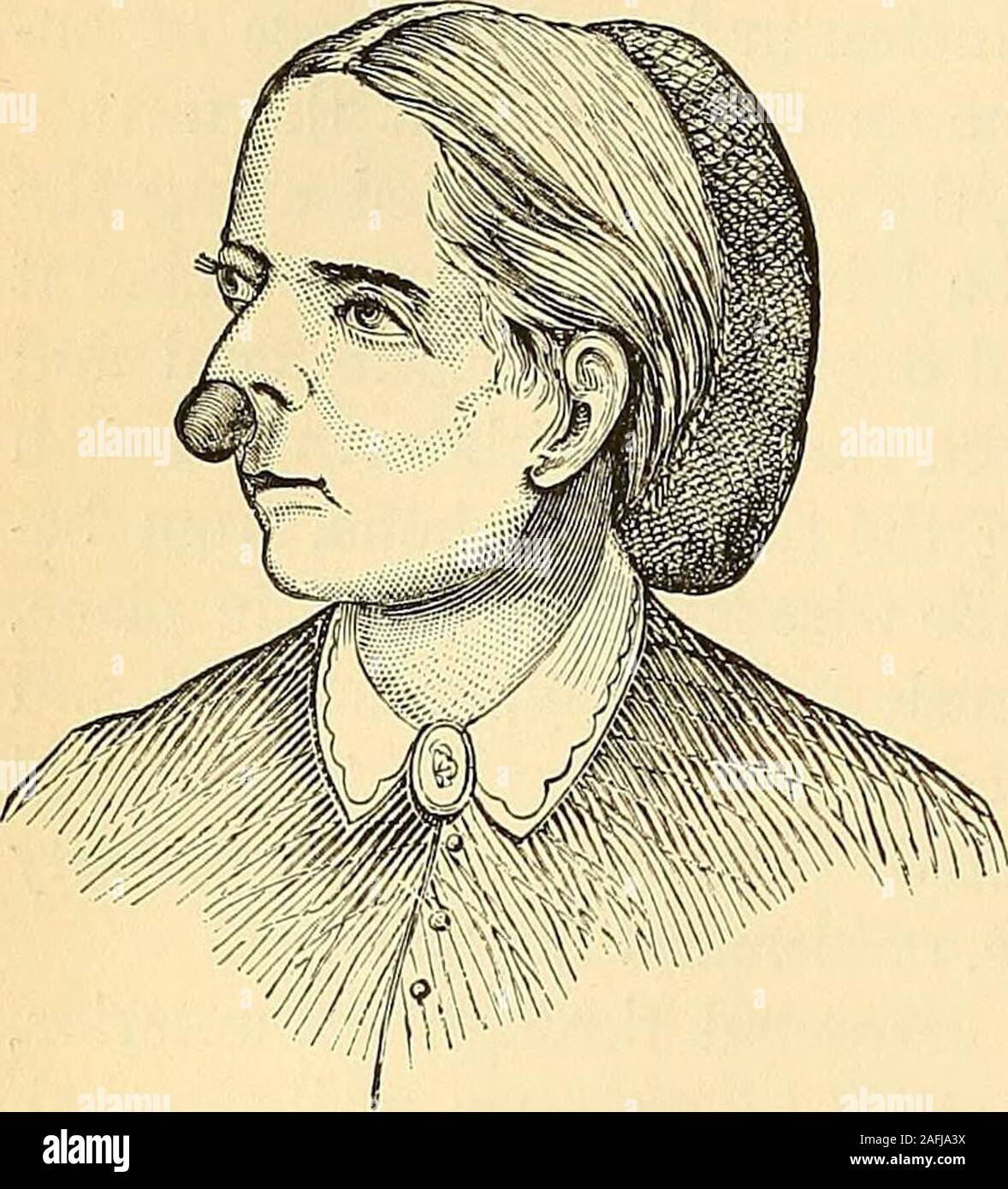 . The principles and practice of surgery. nares. They grow from ...