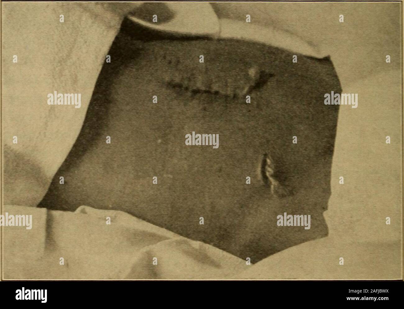 Surgical wound swelling hi-res stock photography and images - Alamy