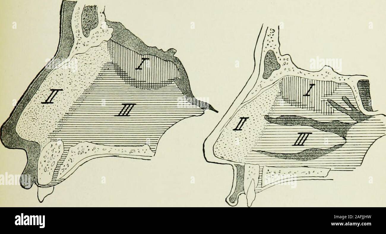 Tonsil membrane hi-res stock photography and images - Alamy