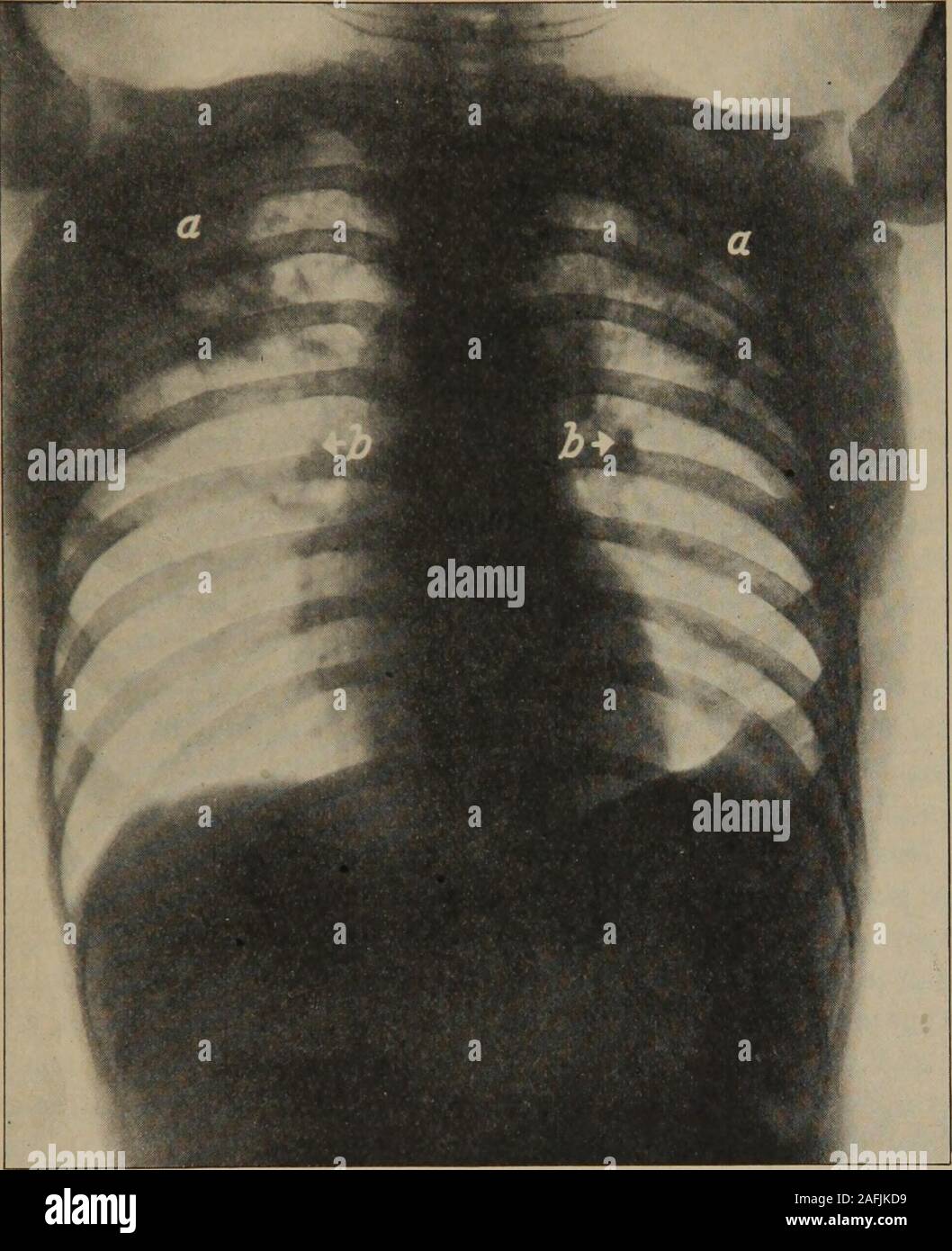 Chest x ray showing tuberculosis hi-res stock photography and images ...