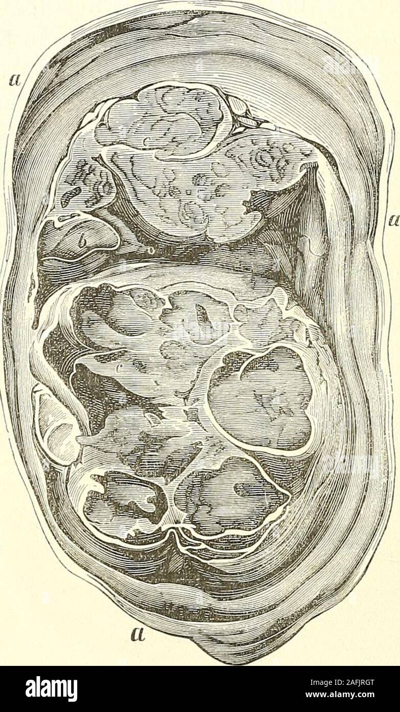 Simple cysts hi-res stock photography and images - Alamy