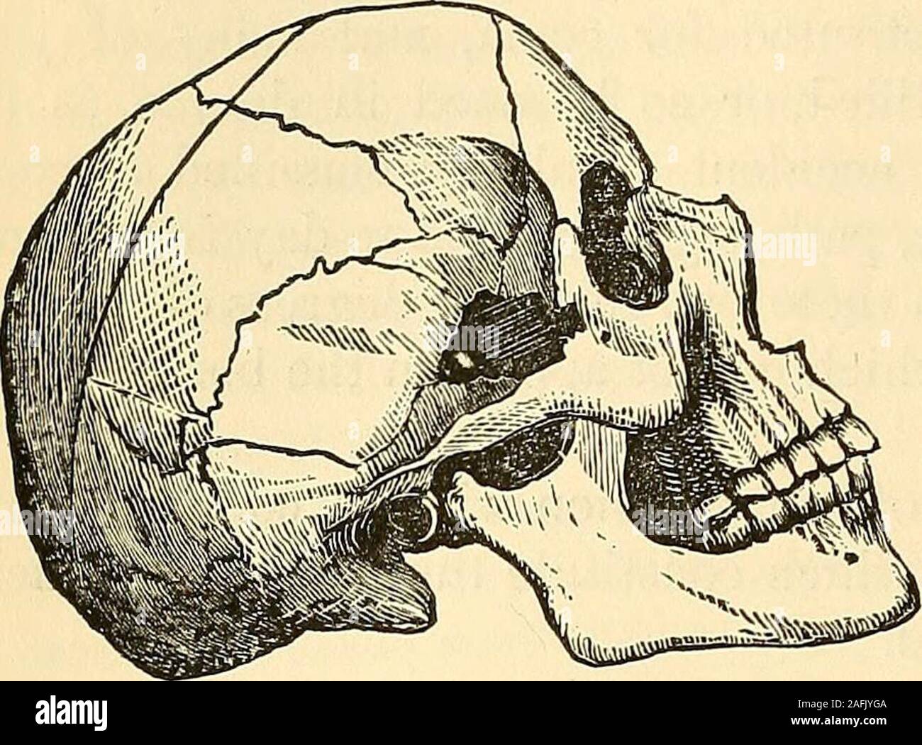 . The principles and practice of surgery. Iron Arrow-head impacted in ...