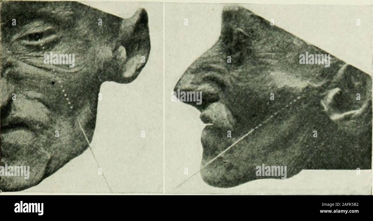 Cranial fossa hi-res stock photography and images - Alamy