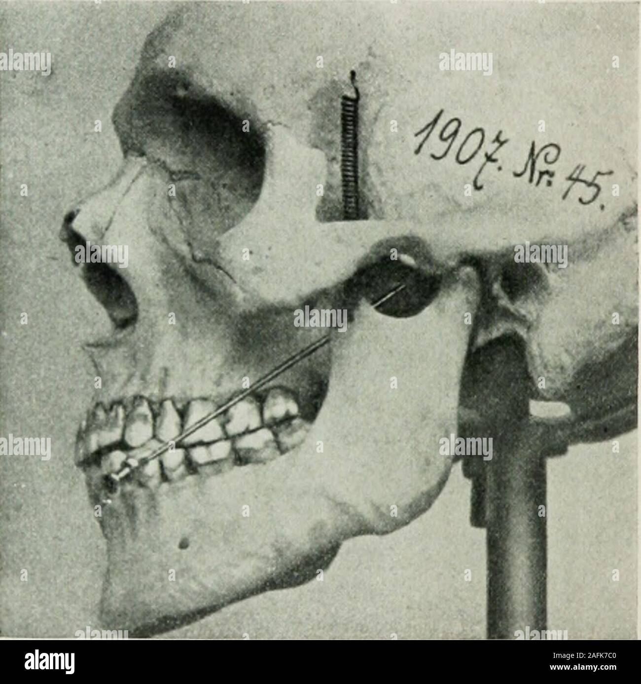 . Local and regional anesthesia : with chapters on spinal, epidural ...