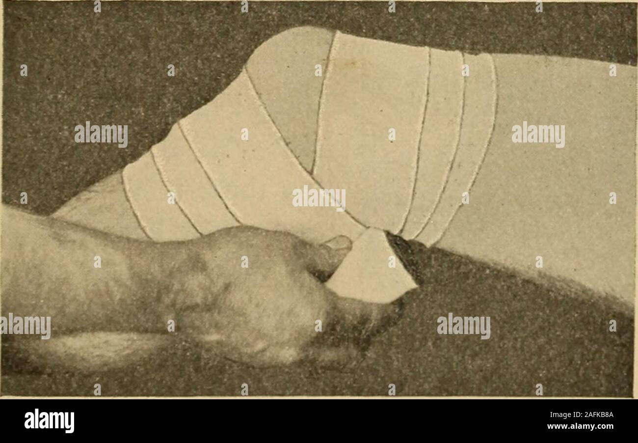 Spiral bandage hi-res stock photography and images - Alamy