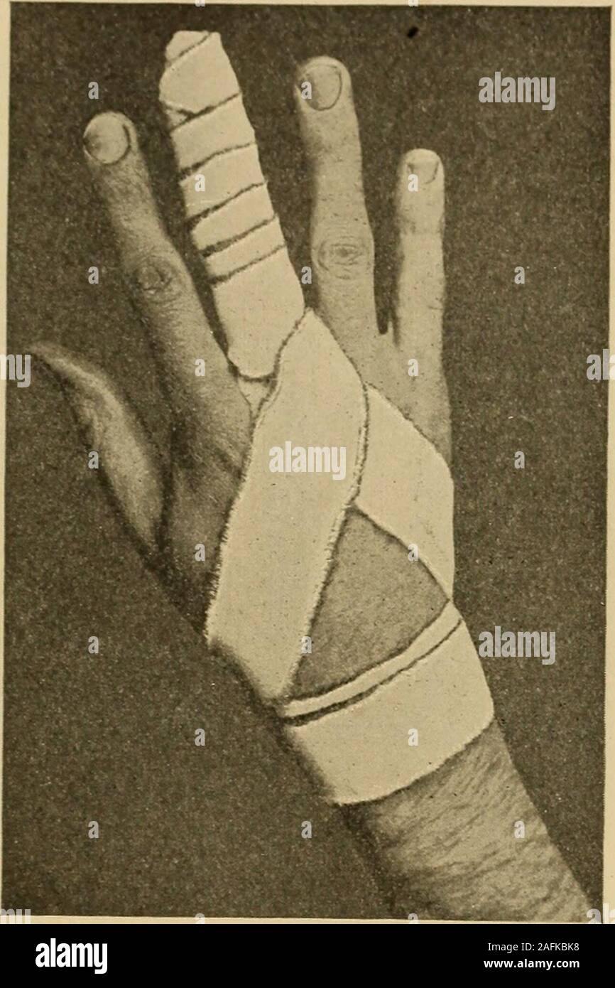 Spica Bandage High Resolution Stock Photography and Images - Alamy