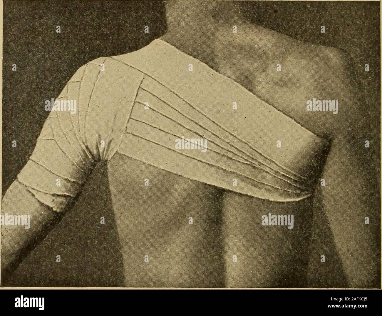 Spica bandage hi-res stock photography and images - Alamy