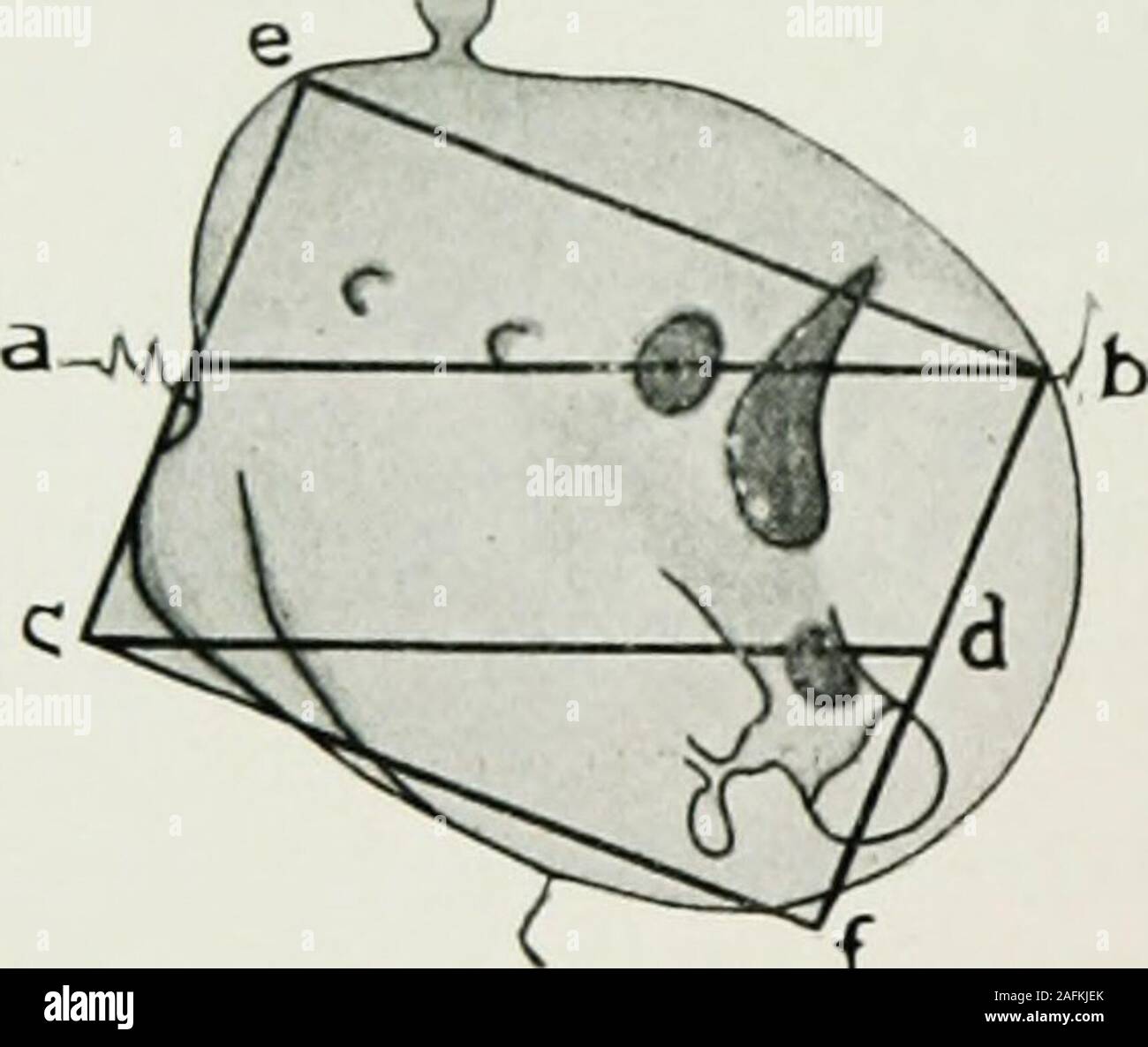 . Local and regional anesthesia : with chapters on spinal, epidural ...