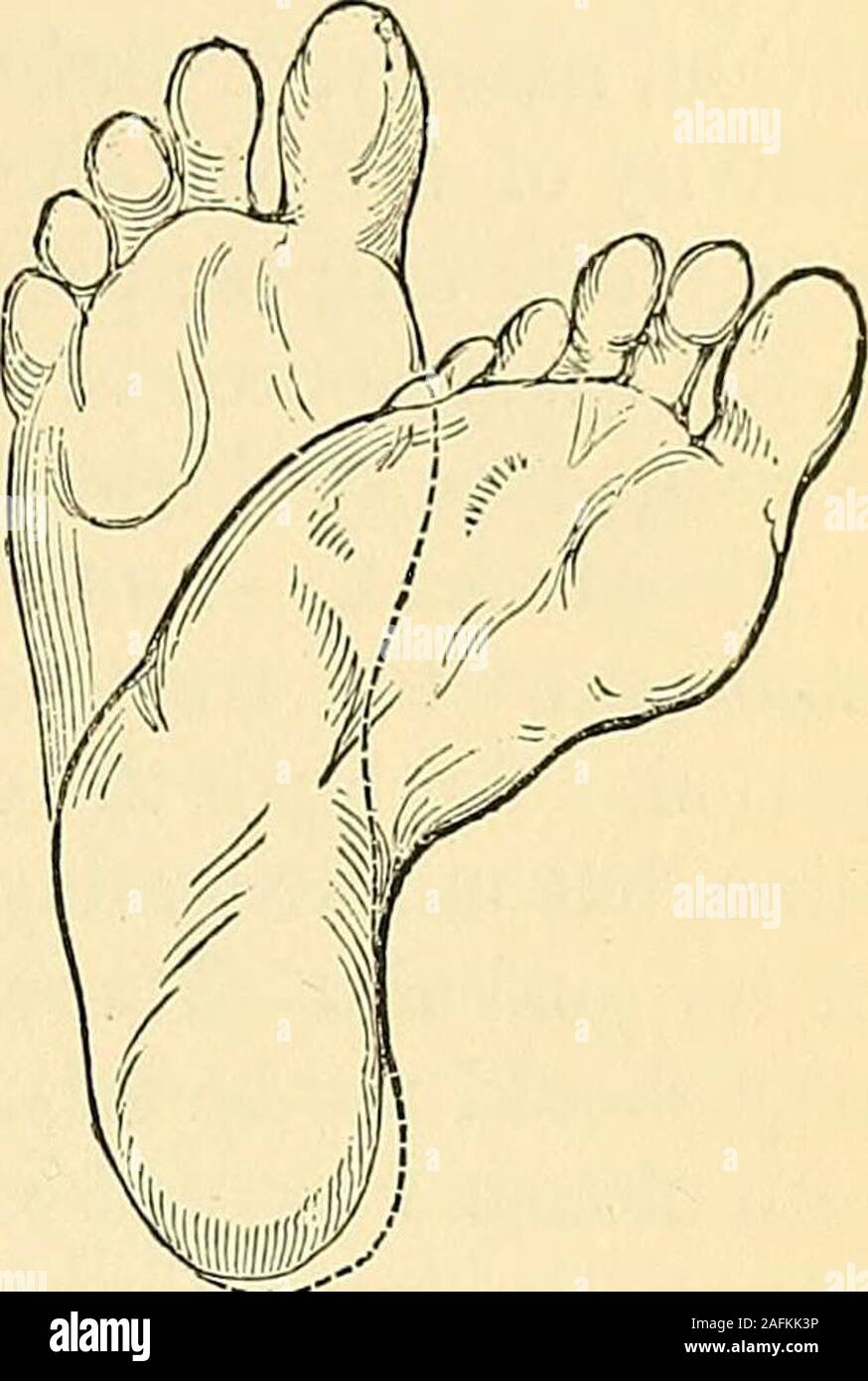 . The principles and practice of surgery. Double Talipes Equino-Varus ...