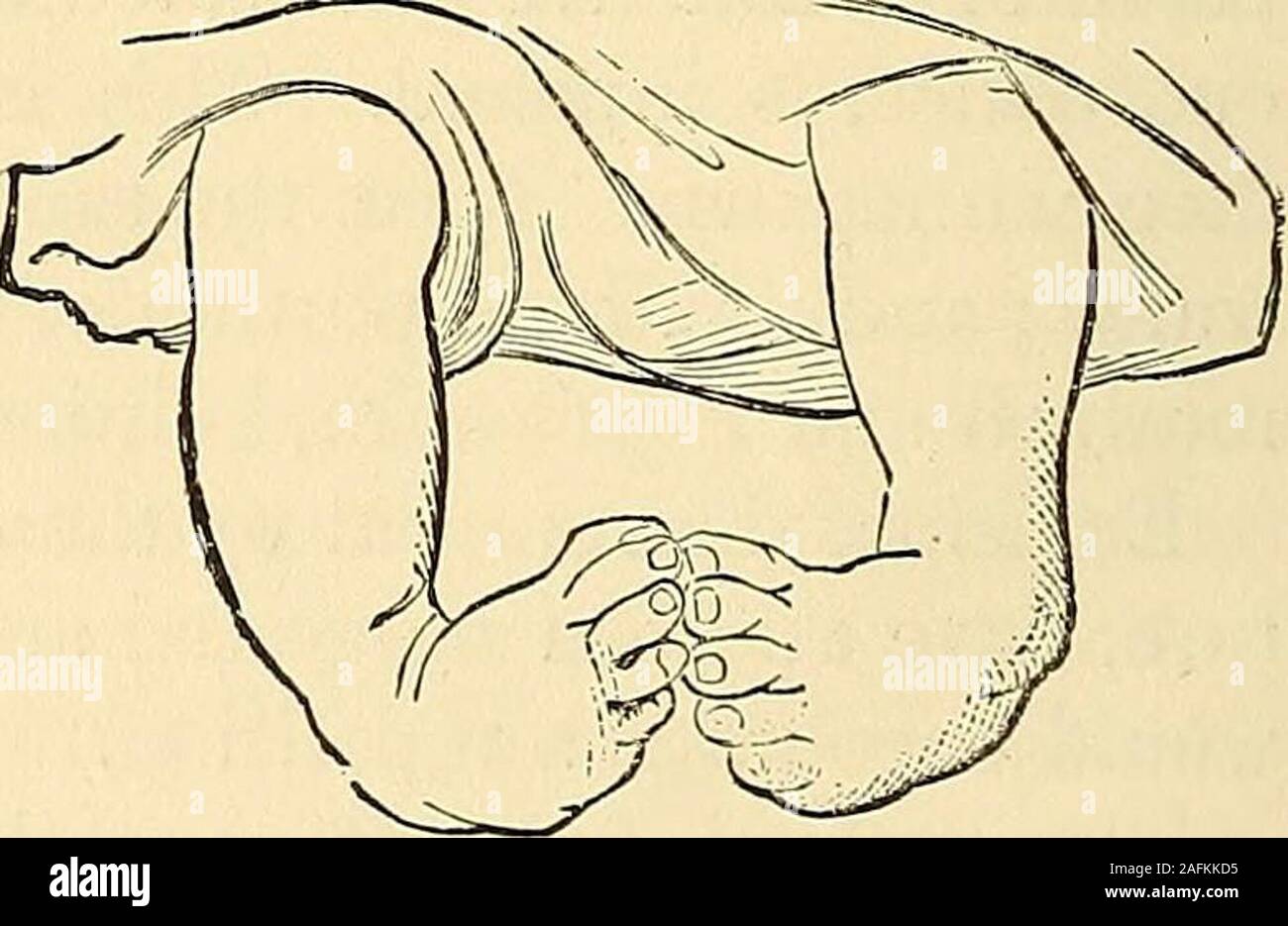 . The principles and practice of surgery. Double Talipes Equino-Varus ...