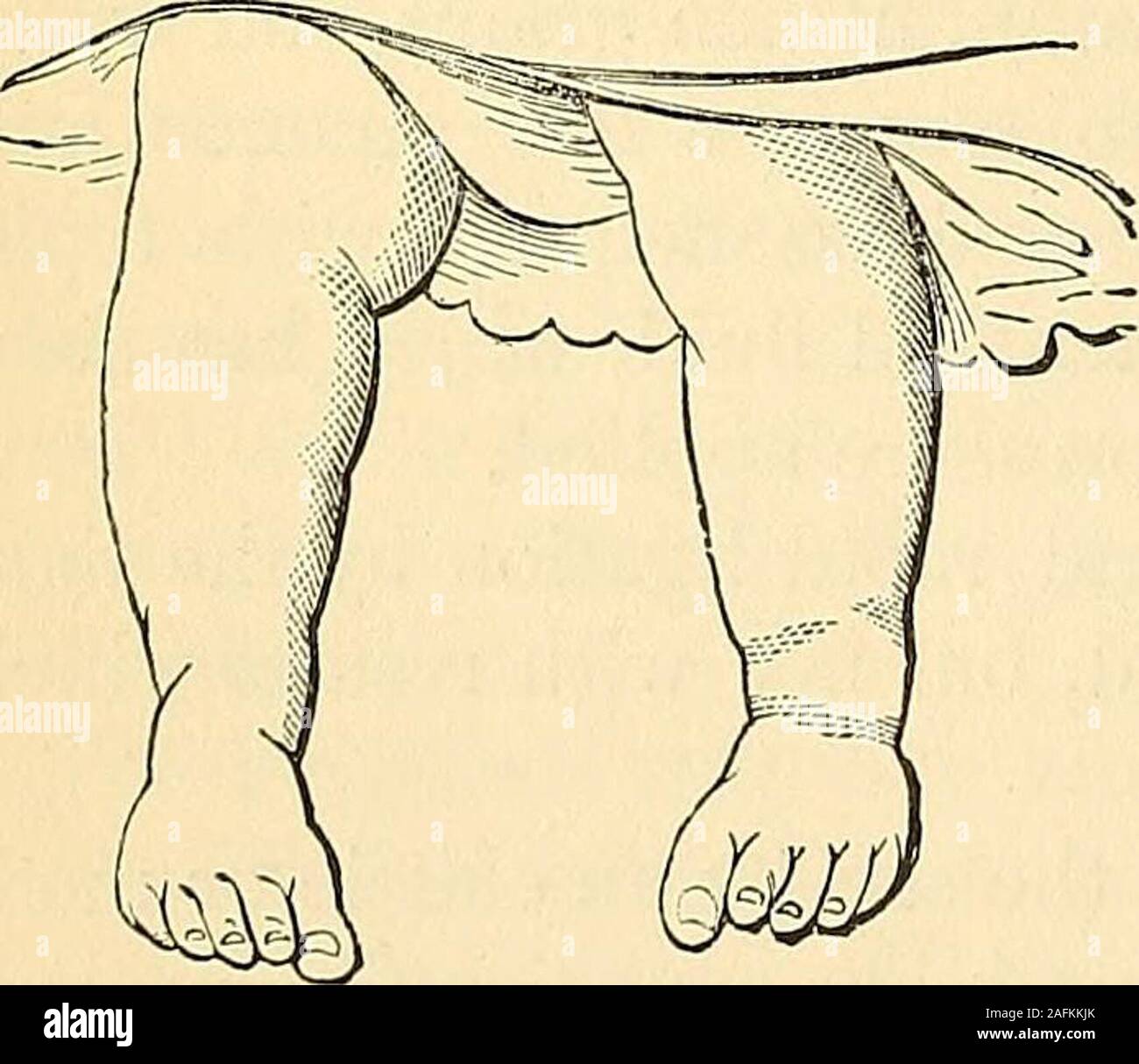 . The principles and practice of surgery. ieties, namely, equino-varus ...