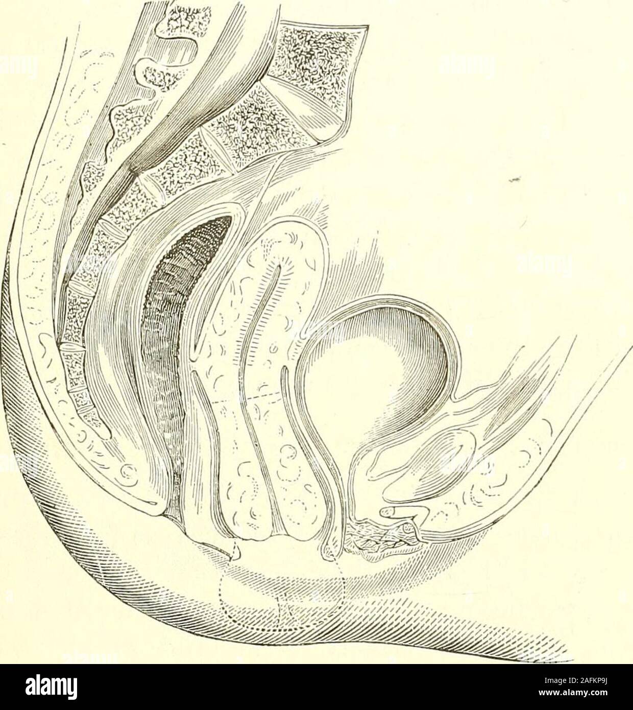 Ostium Uterus