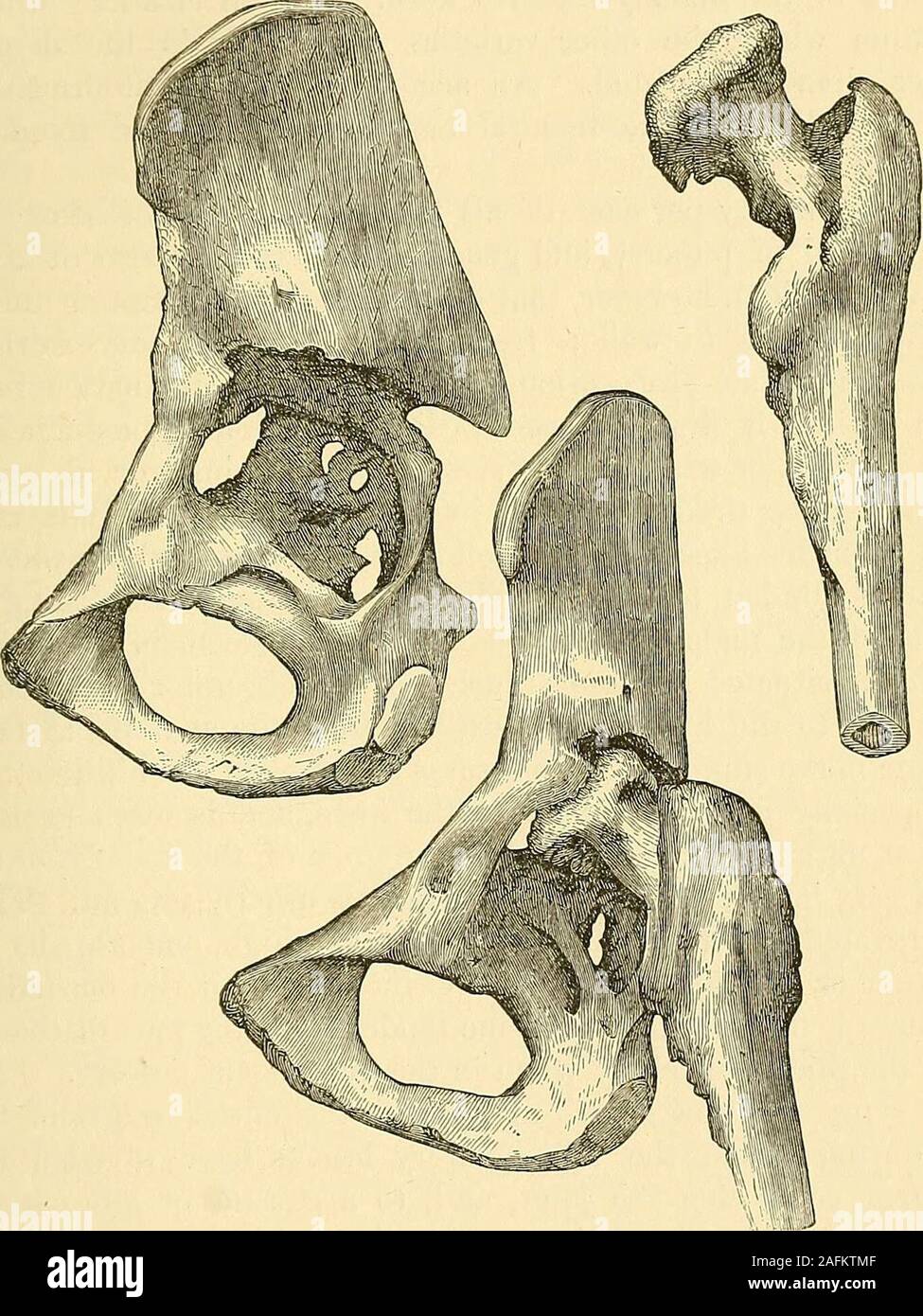 Femoral head arthritis hi-res stock photography and images - Alamy