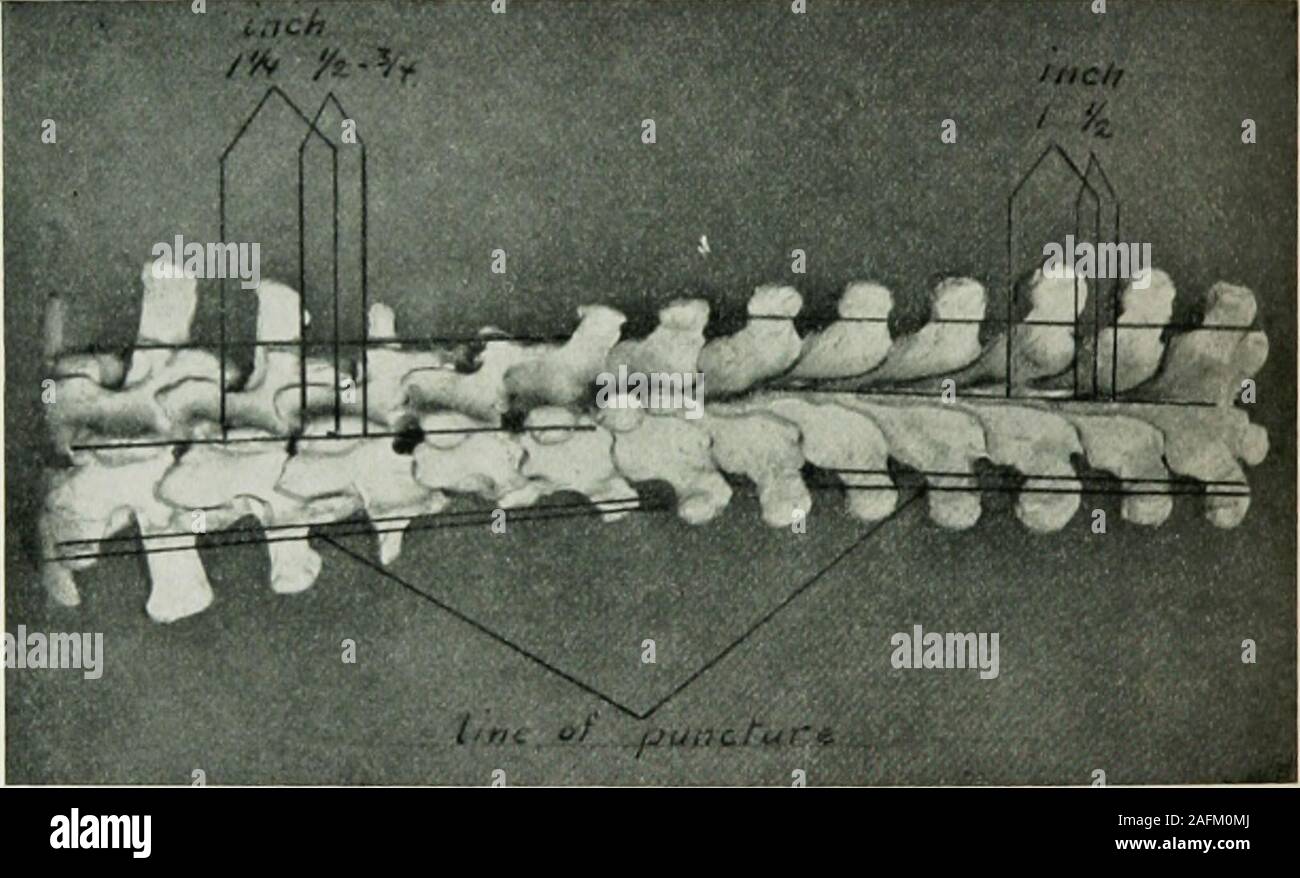 . Local and regional anesthesia : with chapters on spinal, epidural ...