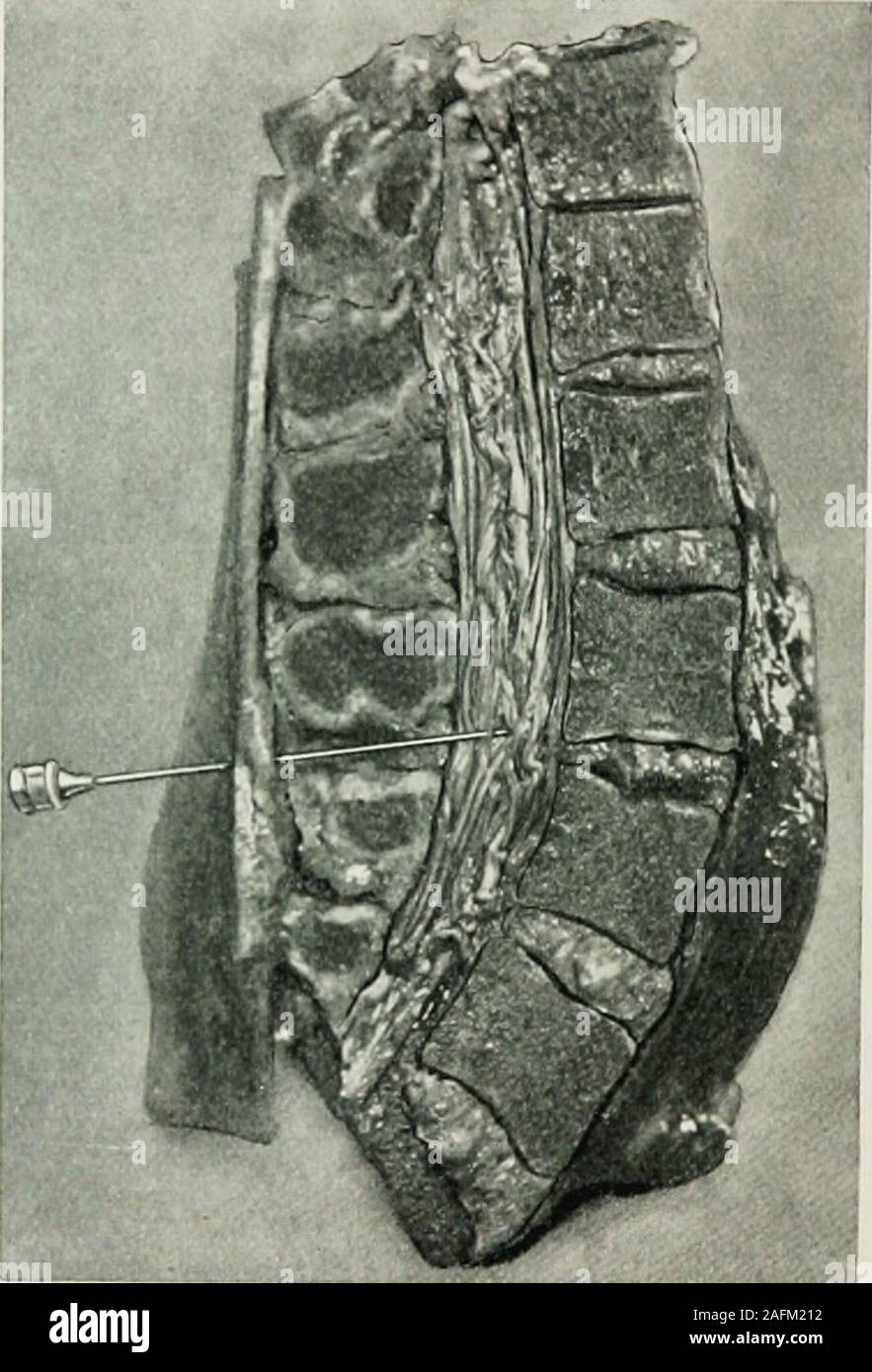 Cauda equina hi-res stock photography and images - Alamy