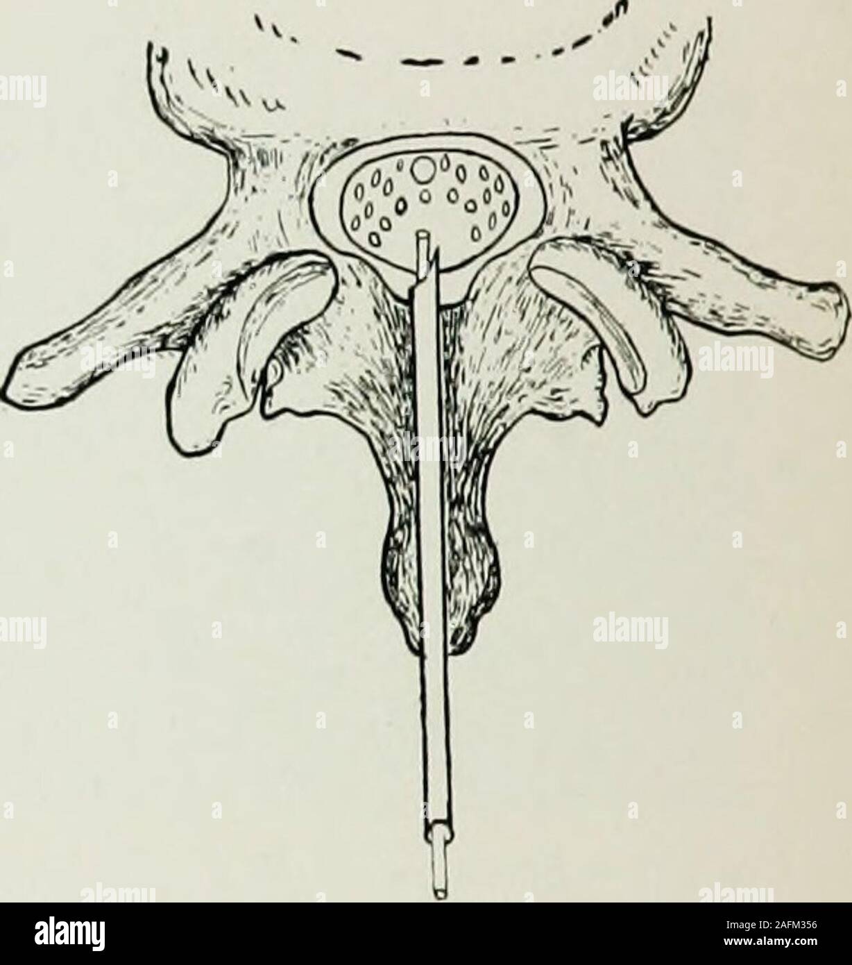 . Local and regional anesthesia : with chapters on spinal, epidural ...