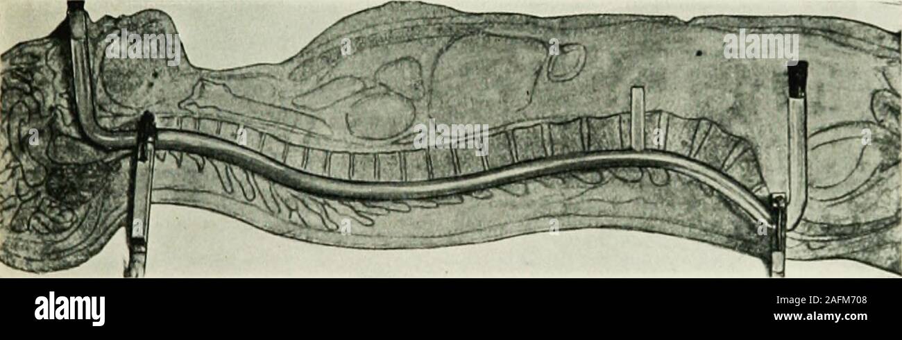 . Local and regional anesthesia : with chapters on spinal, epidural ...