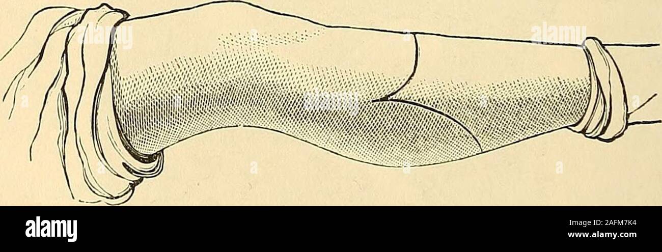 . The principles and practice of surgery. /Authors Lines of Incision ...