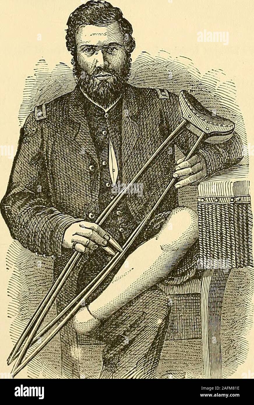 . The principles and practice of surgery. PirogofFs Operation. stump ...