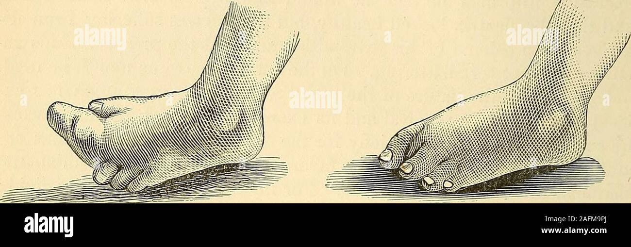 Amputated toe hi-res stock photography and images - Alamy