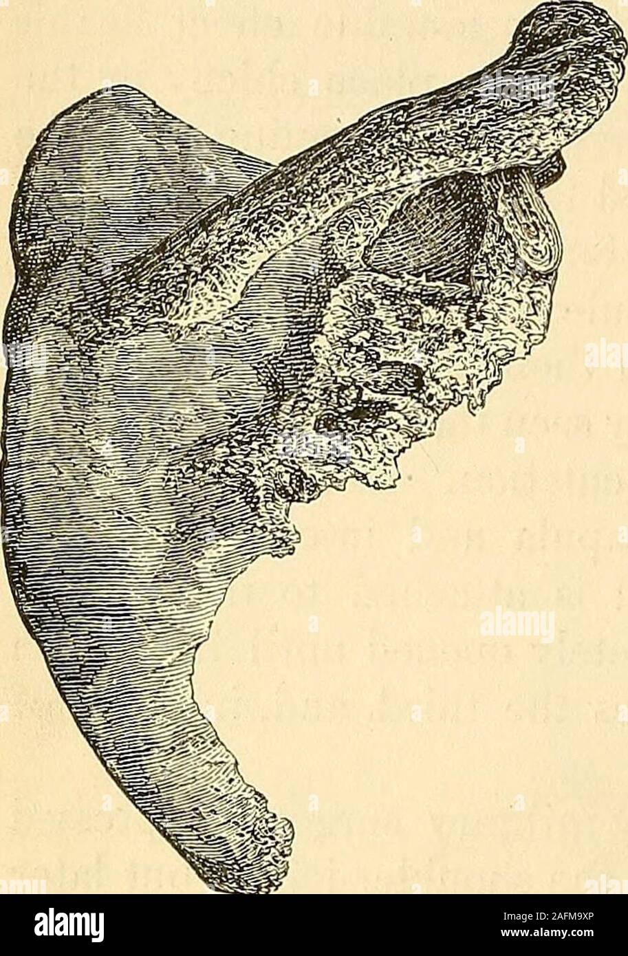 Clavicle excision hi-res stock photography and images - Alamy