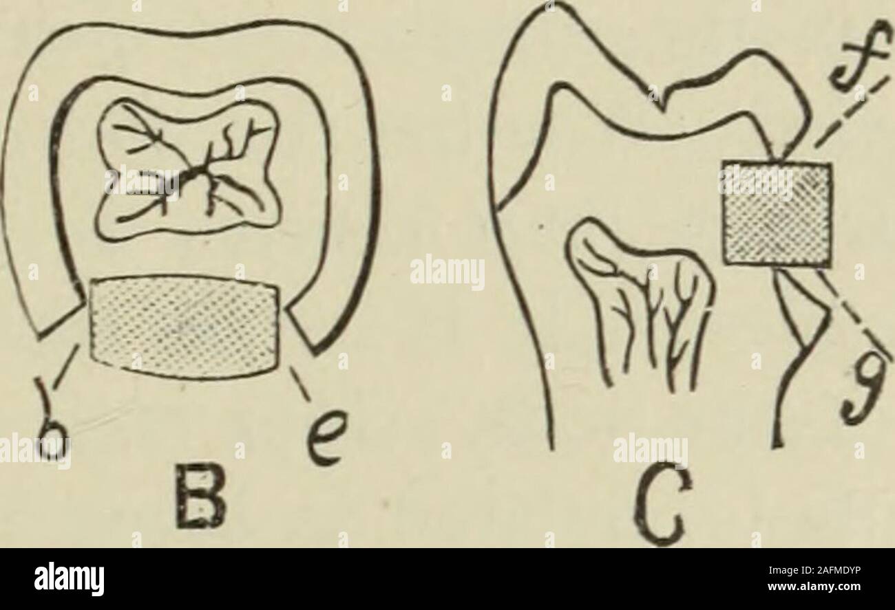 Defective teeth hi-res stock photography and images - Alamy