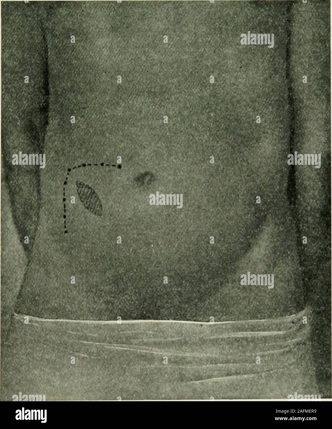 . Local and regional anesthesia : with chapters on spinal, epidural ...