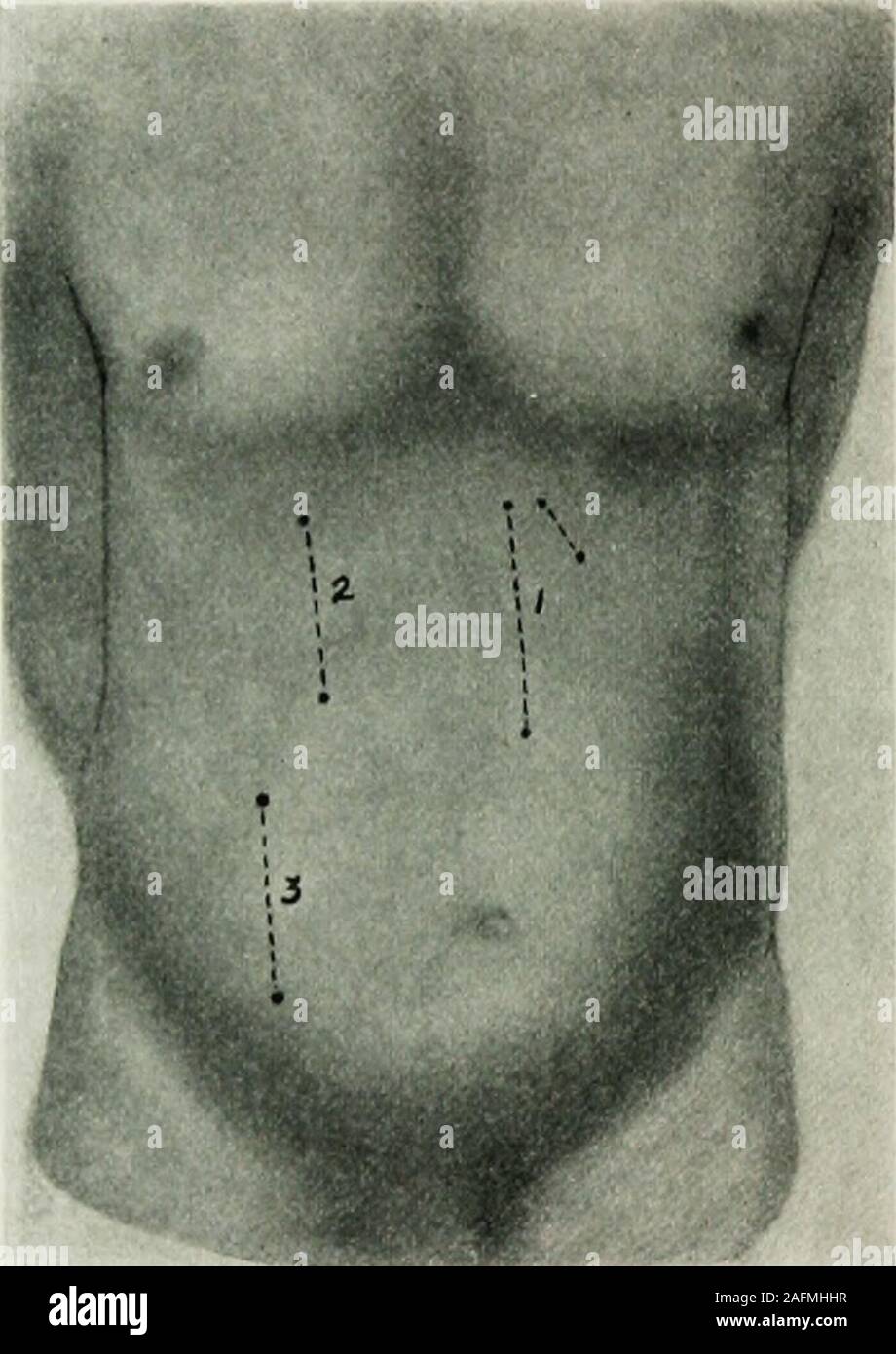 Enterostomy hi-res stock photography and images - Alamy