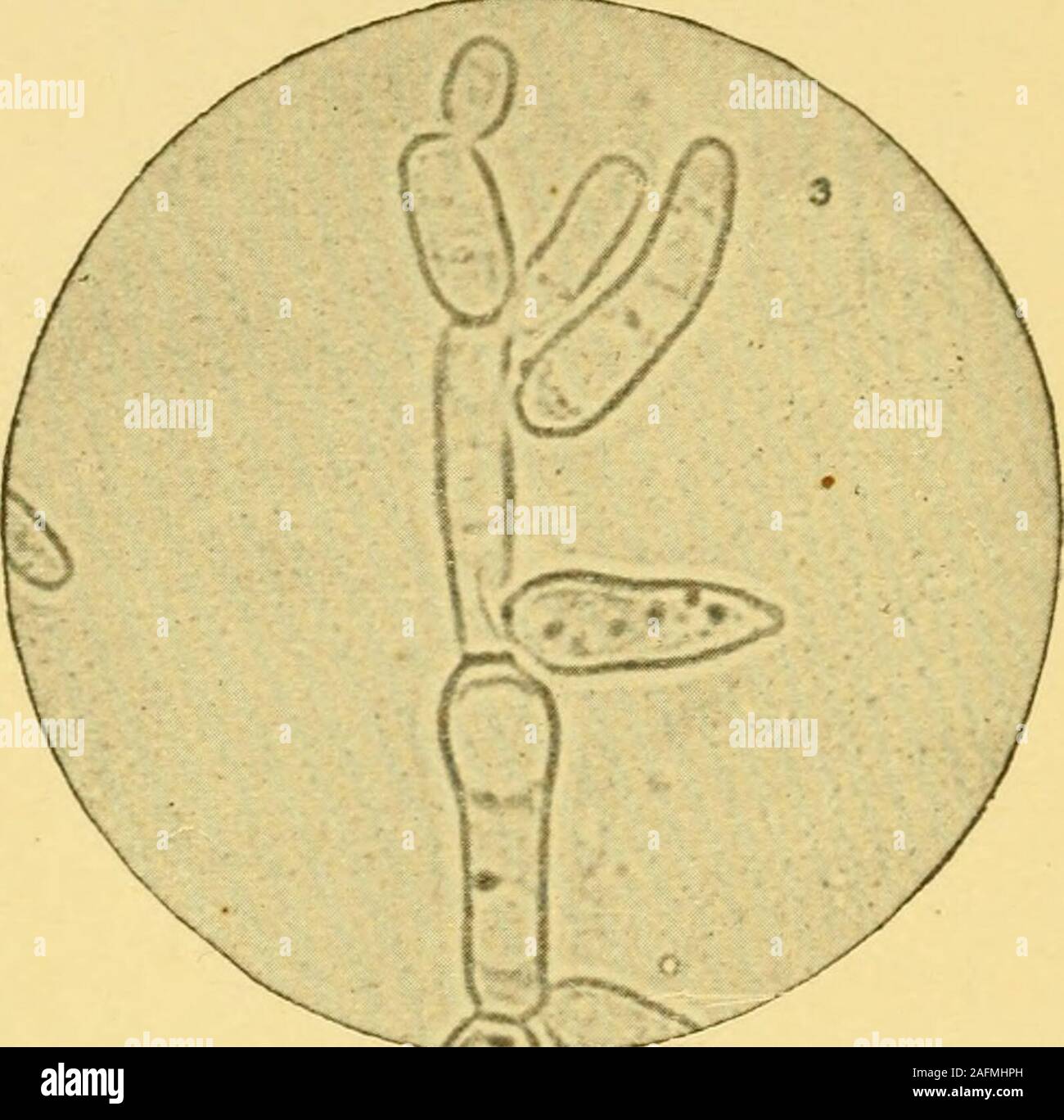 Pityriasis versicolor hi-res stock photography and images - Alamy