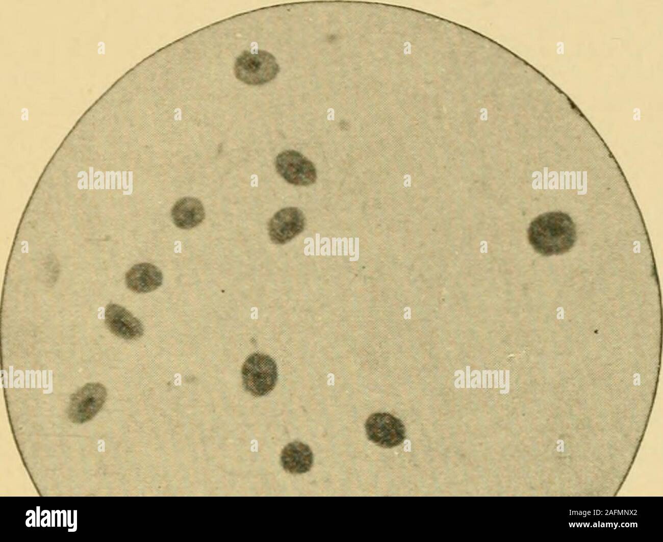 Pyelitis hi-res stock photography and images - Alamy