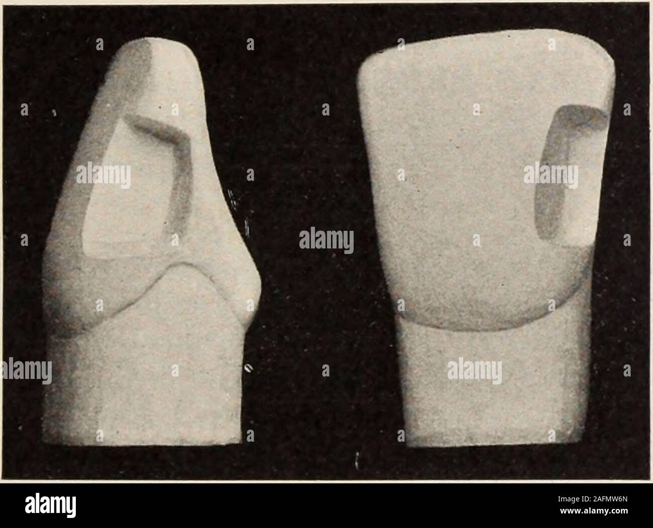 . Dental summary.. normal occlusion. In preparing a single proximal ...