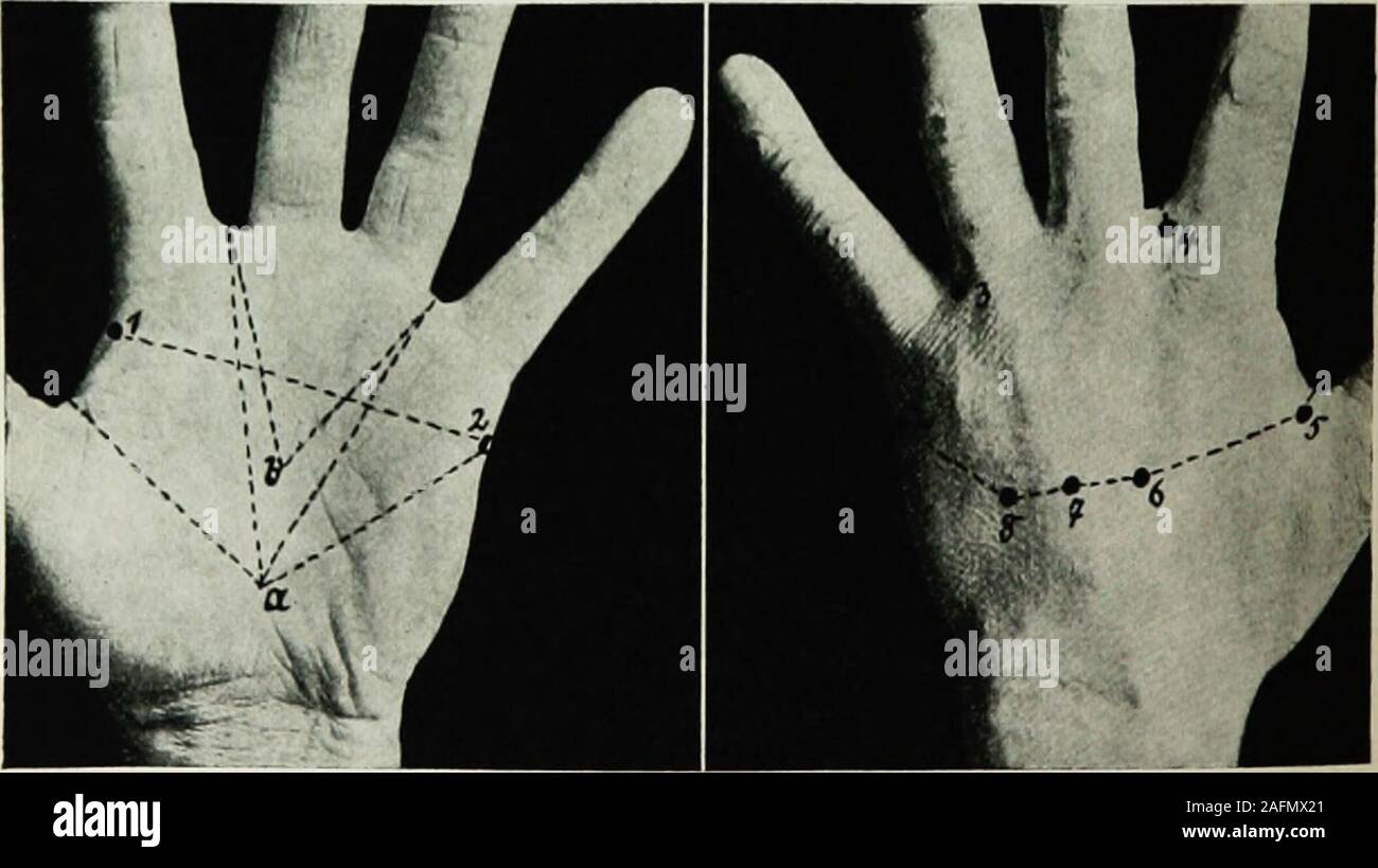 . Local and regional anesthesia : with chapters on spinal, epidural ...