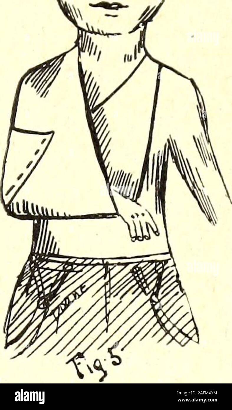 . The Corpuscle.. Radio-Cervical Triangle. Flex forearm at right angles ...