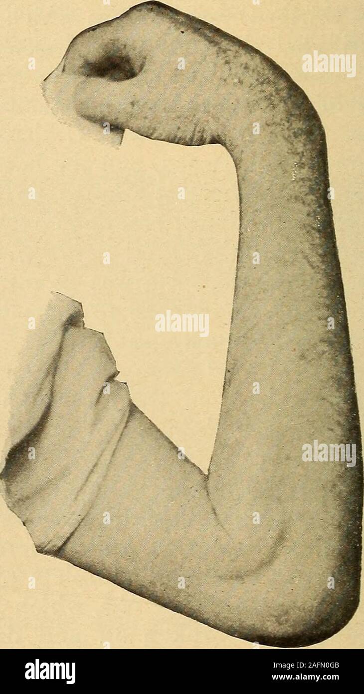 . A practical treatise on fractures and dislocations. New formation of ...