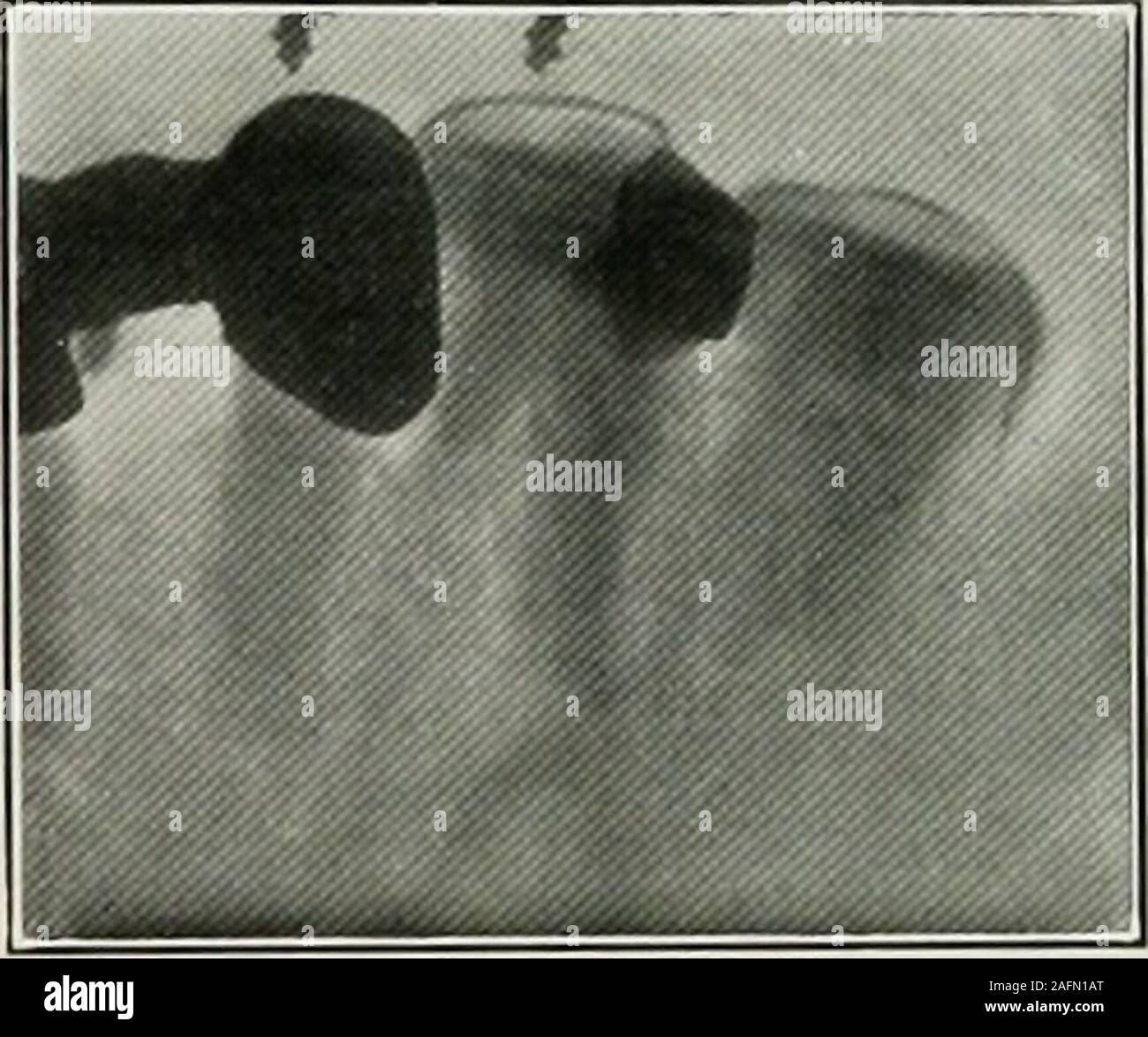 . Dental electro-therapeutics. Fig. 156.—Radiograph January 29, 1907 ...