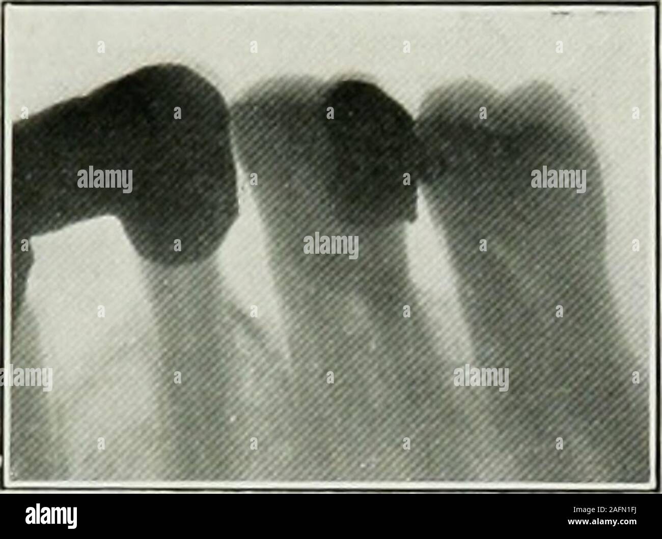 Bony socket hi-res stock photography and images - Alamy