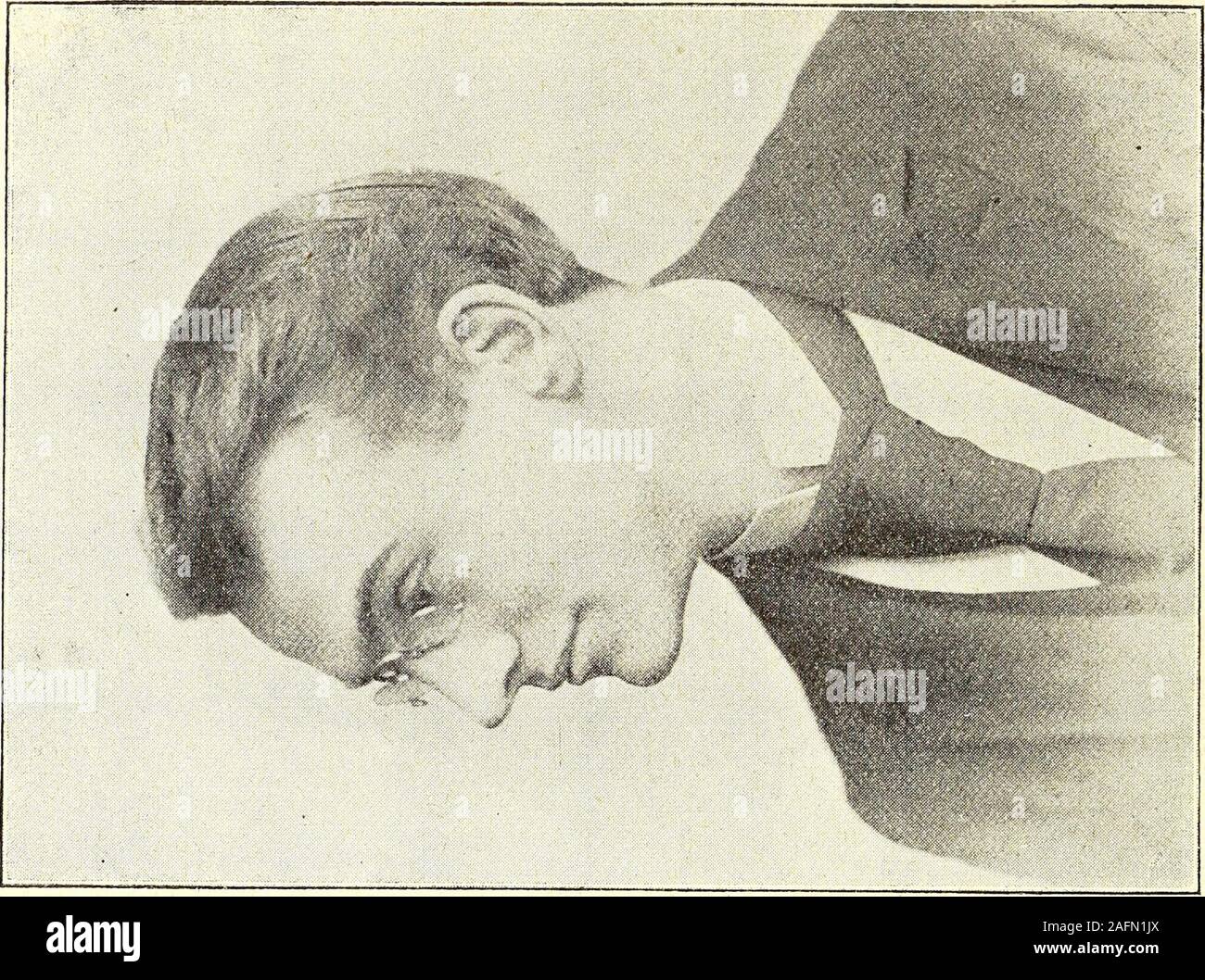 Carbuncles hi-res stock photography and images - Alamy