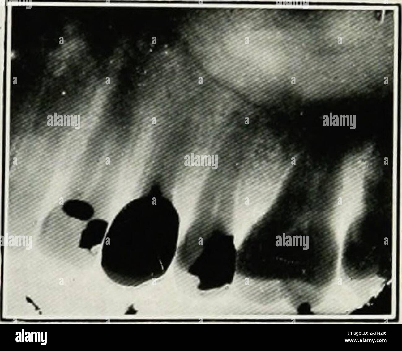 Hard tooth extraction hi-res stock photography and images - Alamy