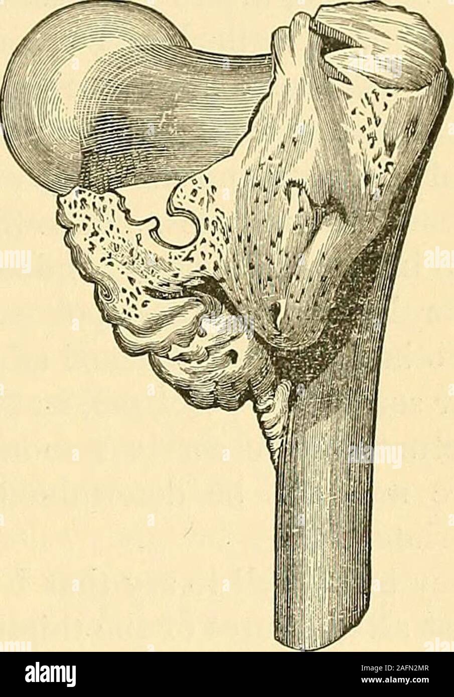 . The principles and practice of surgery. Impacted Extra-capsular ...