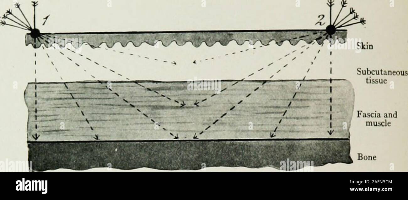 . Local and regional anesthesia : with chapters on spinal, epidural ...