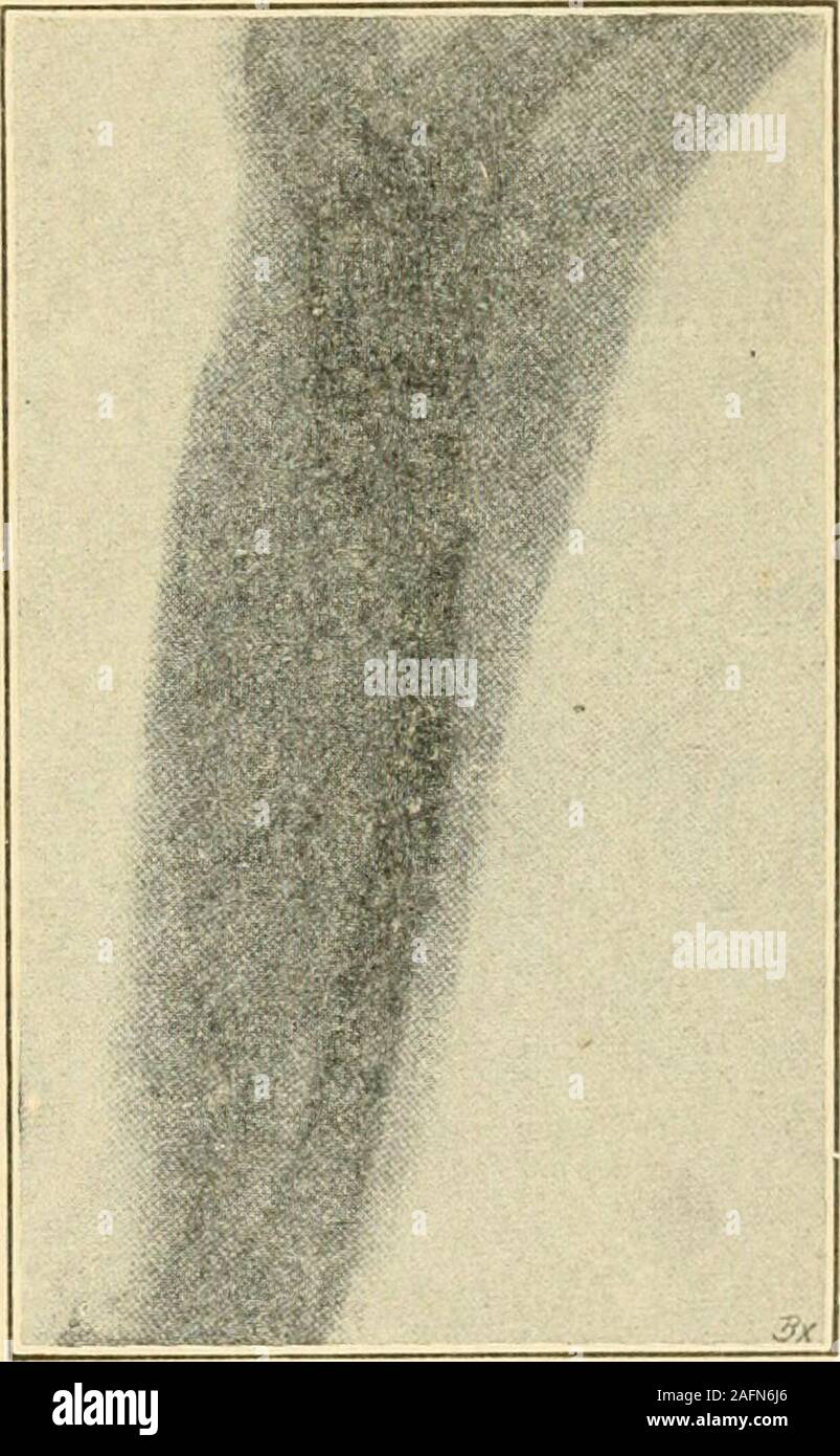 Osteomalacia bone hi-res stock photography and images - Alamy