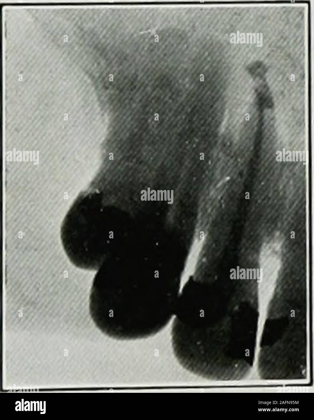 Nerve extraction hi-res stock photography and images - Alamy