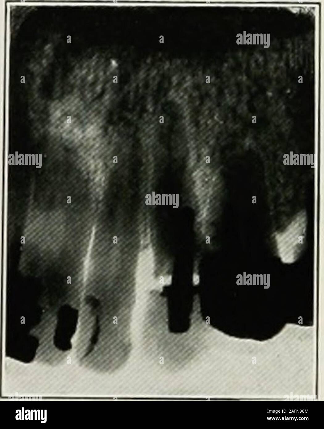 Rootcanal hi-res stock photography and images - Alamy