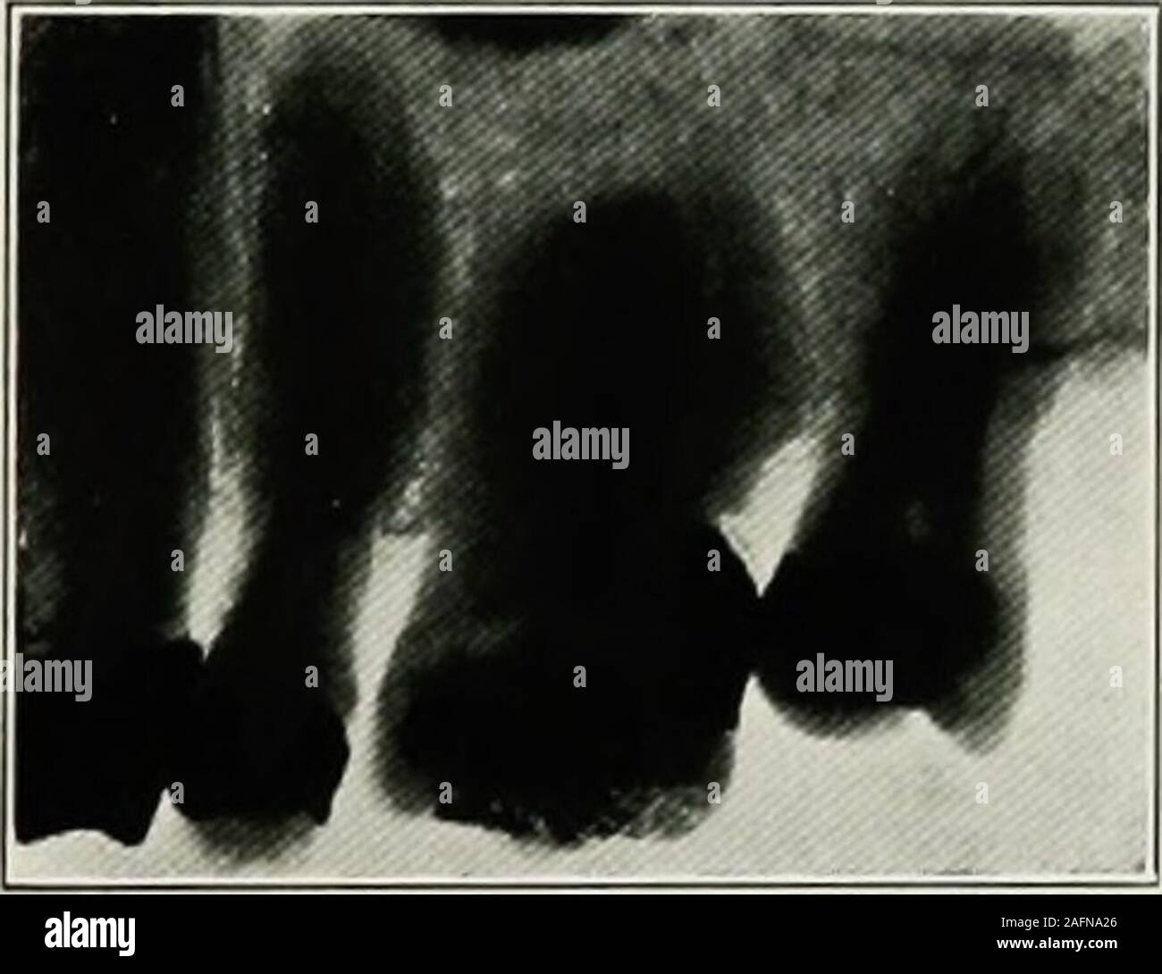 . Dental electro-therapeutics. Fig. 121. Fig. 122.—Taken by Dr. H. F ...