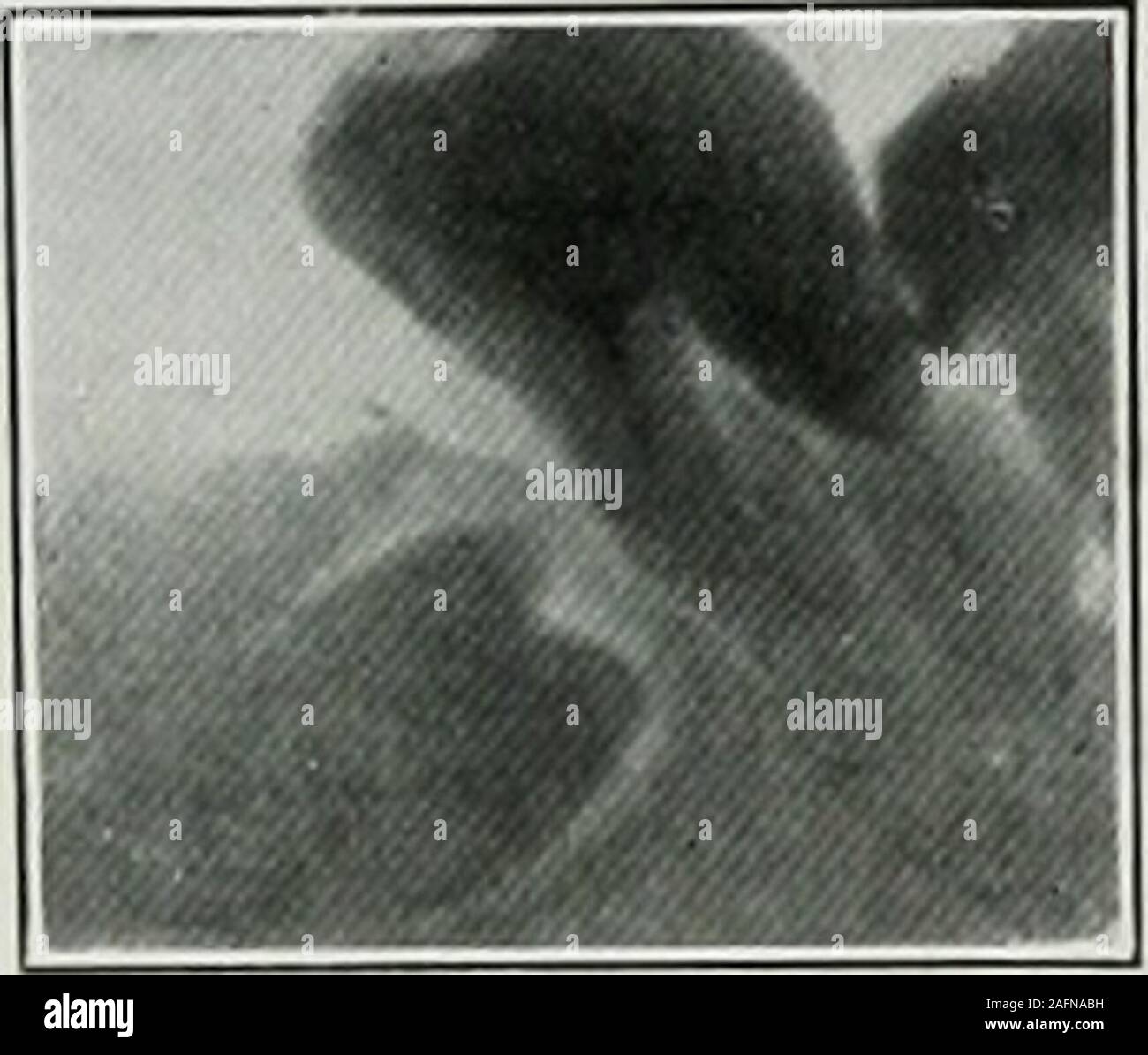 Empyema test hi-res stock photography and images - Alamy