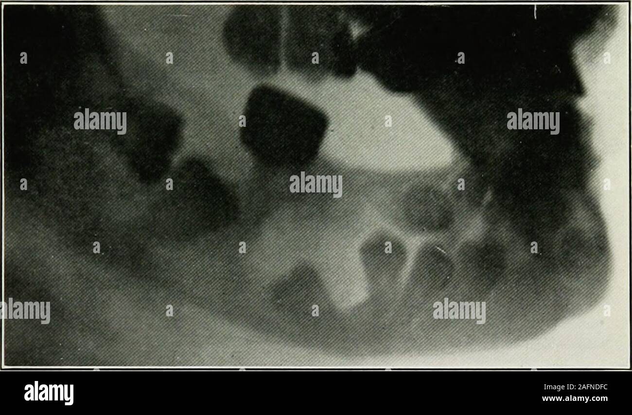 . Dental electro-therapeutics. Fg. 107.—A case of fistula opening on ...
